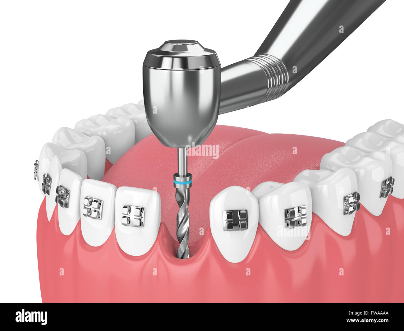3d render of teeth with orthodontic braces and dental drill ...