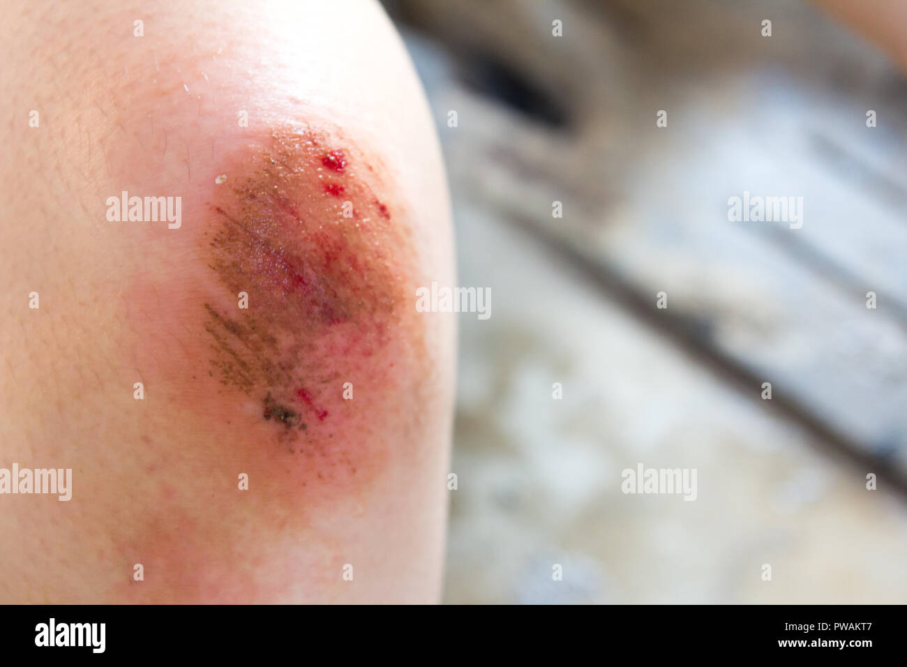 Bruised Leg Stock Photos & Bruised Leg Stock Images - Alamy