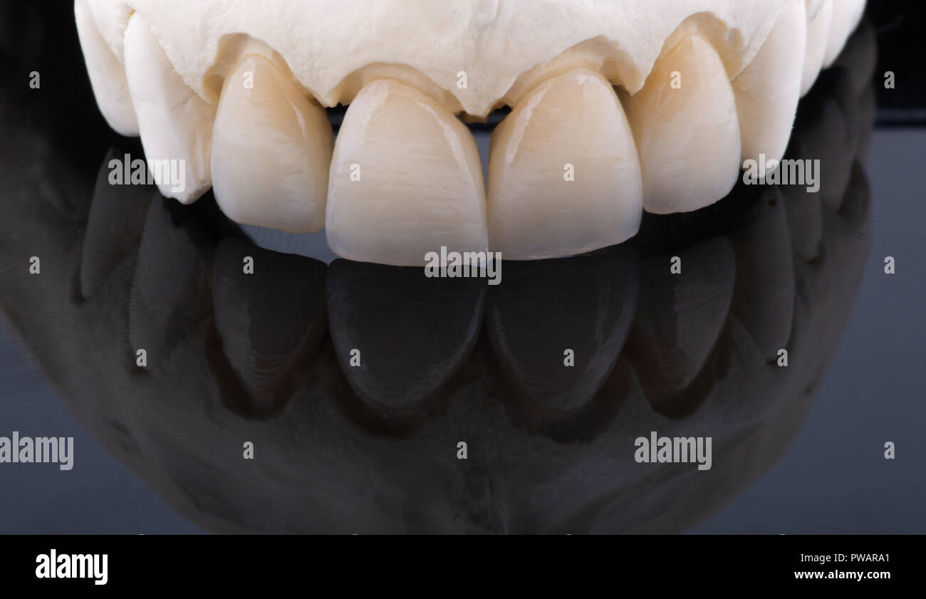 Ceramic teeth on a plaster model with a black background Stock Photo ...