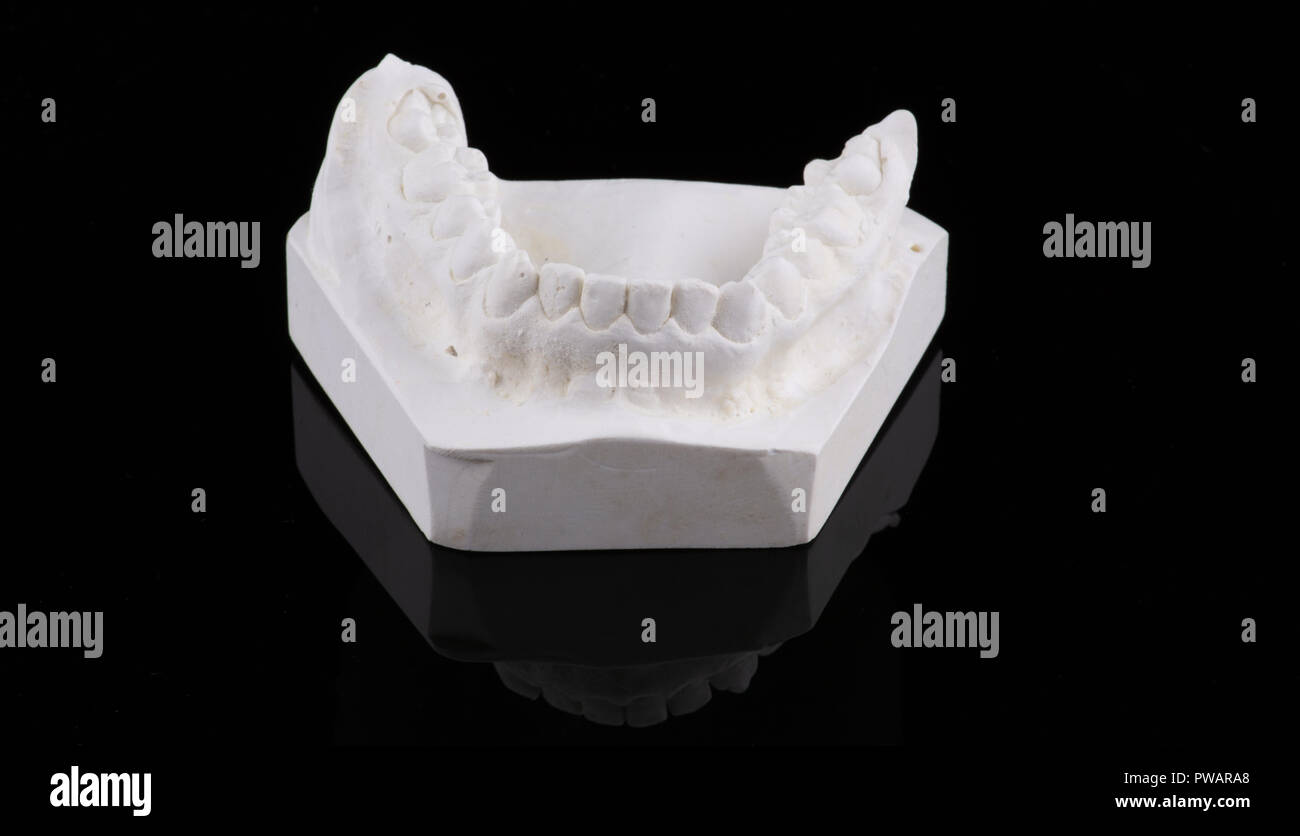 Wax pattern teeth dental crowns on model, metal free - front view ...