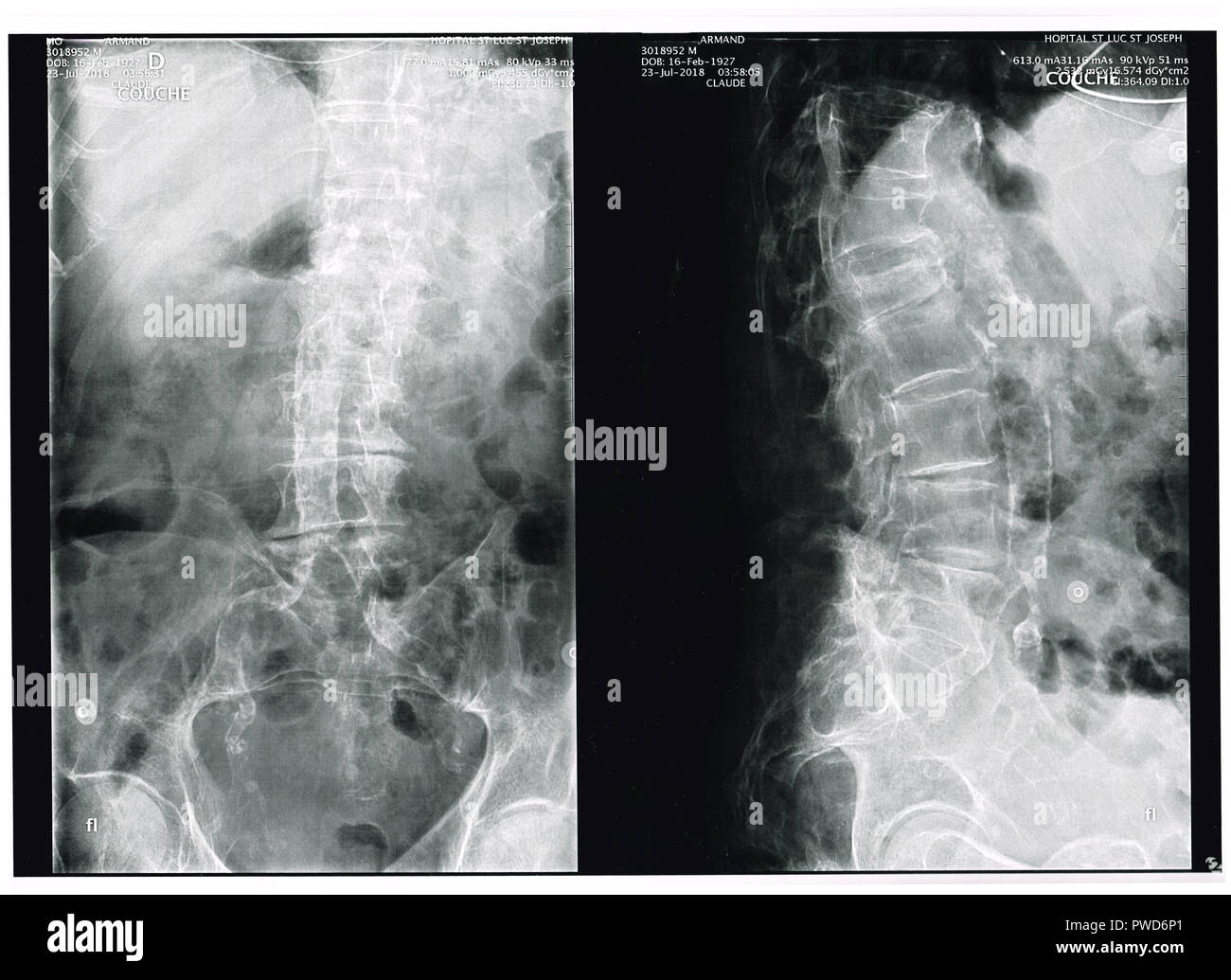 Spine radiography of a 91 years old patient, Lyon, France Stock Photo ...