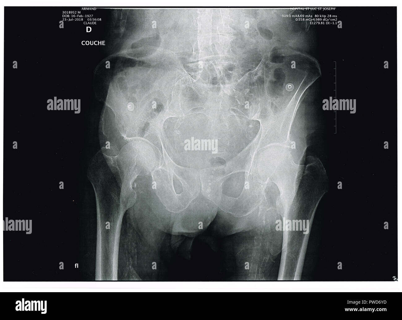 Pelvis radiography of a 91 years old patient, Lyon, France Stock Photo ...