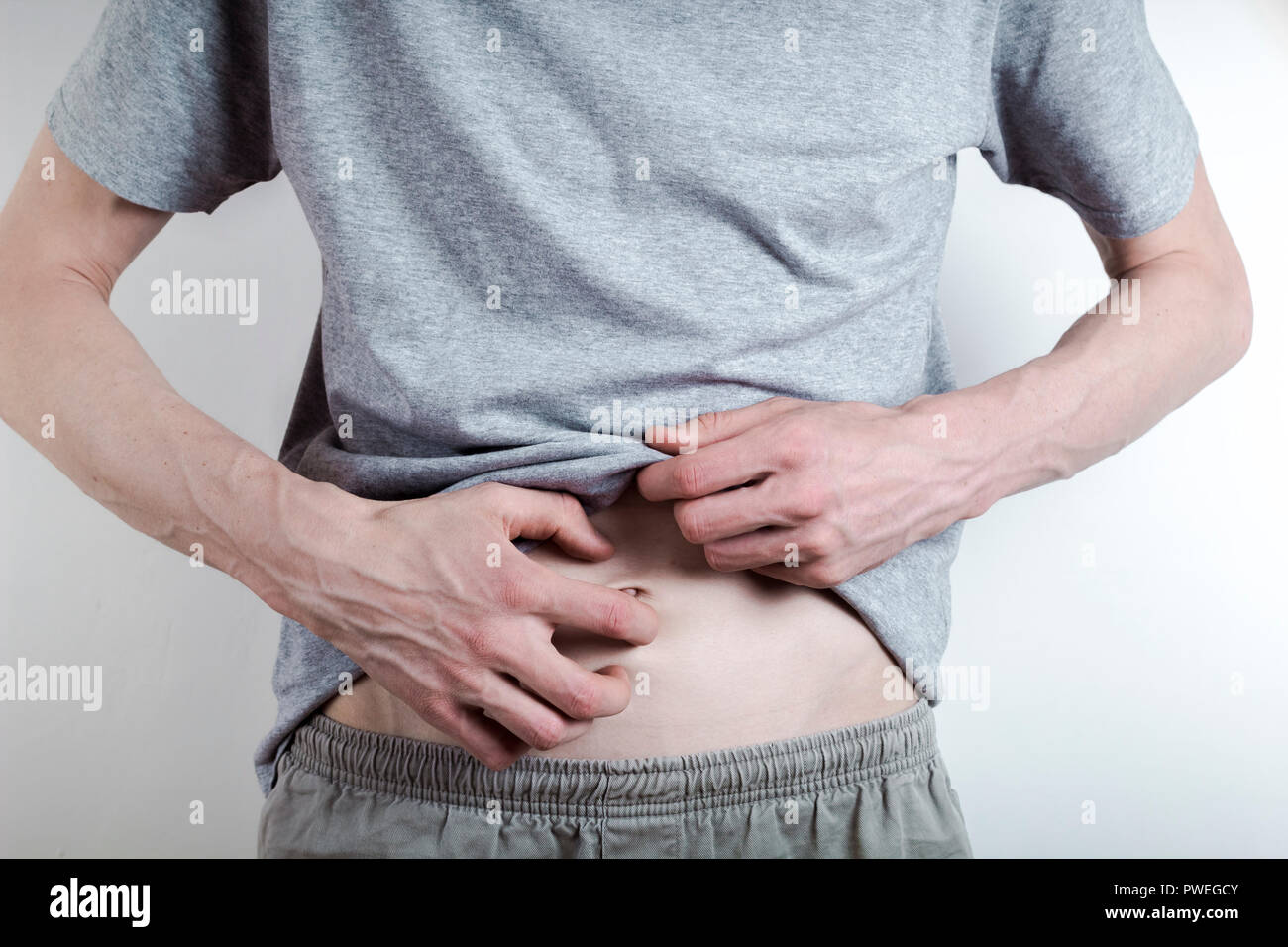 The concept of scabies. The man scratches his arm. Irritation. Drying ...