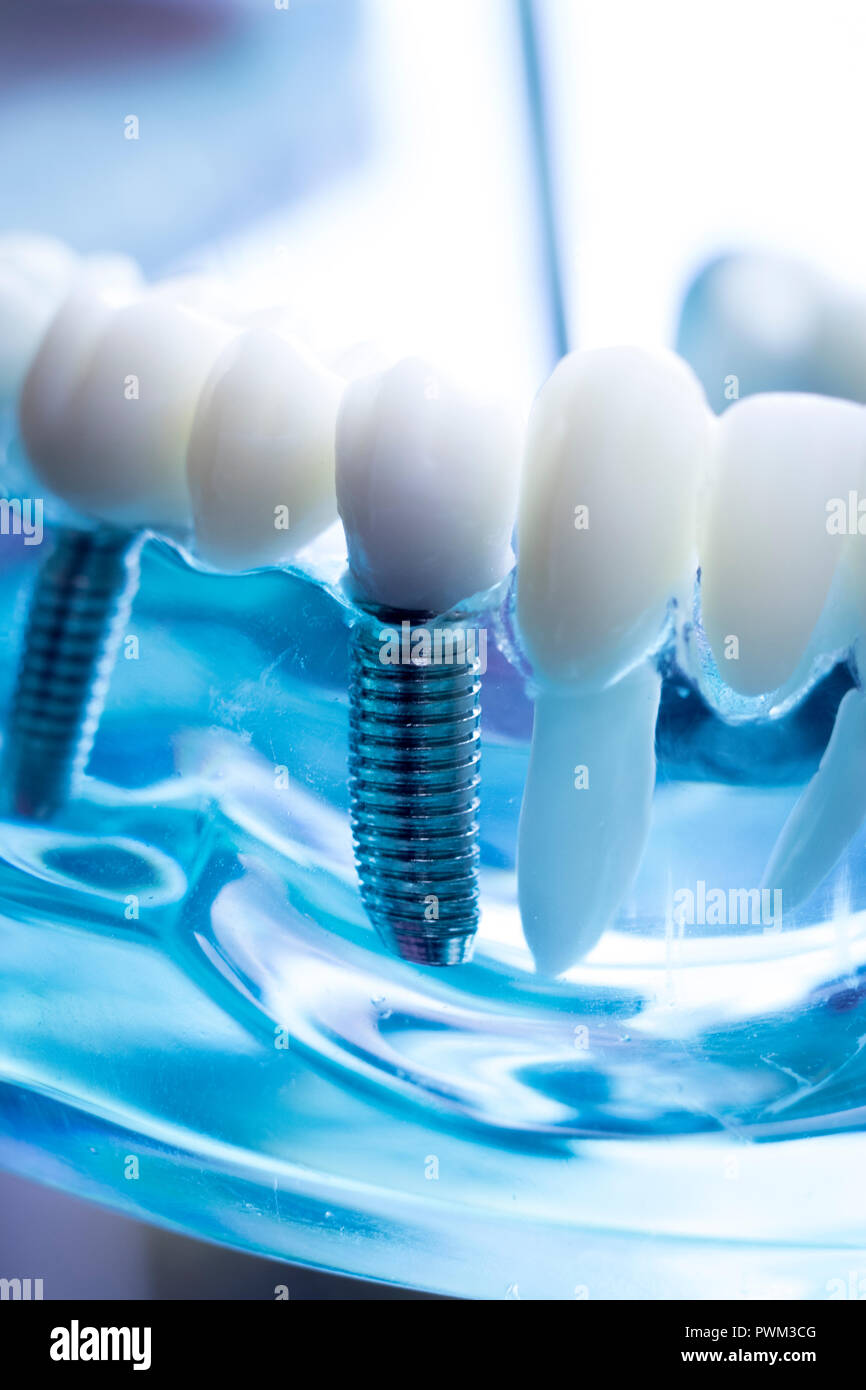 Dentist dental teeth teaching model showing titanium metal tooth ...