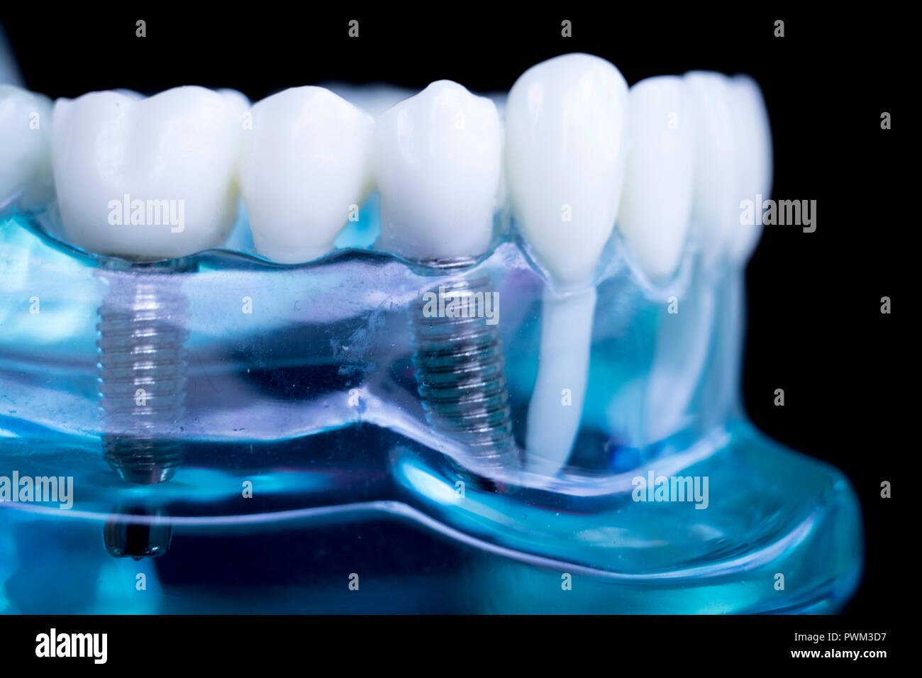 Dentist dental teeth teaching model showing titanium metal tooth ...