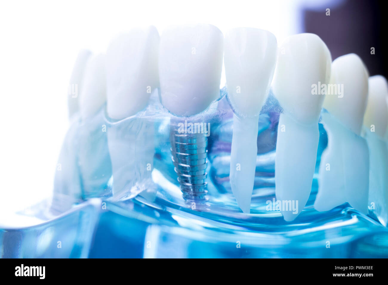 Dentist dental teeth teaching model showing titanium metal tooth ...