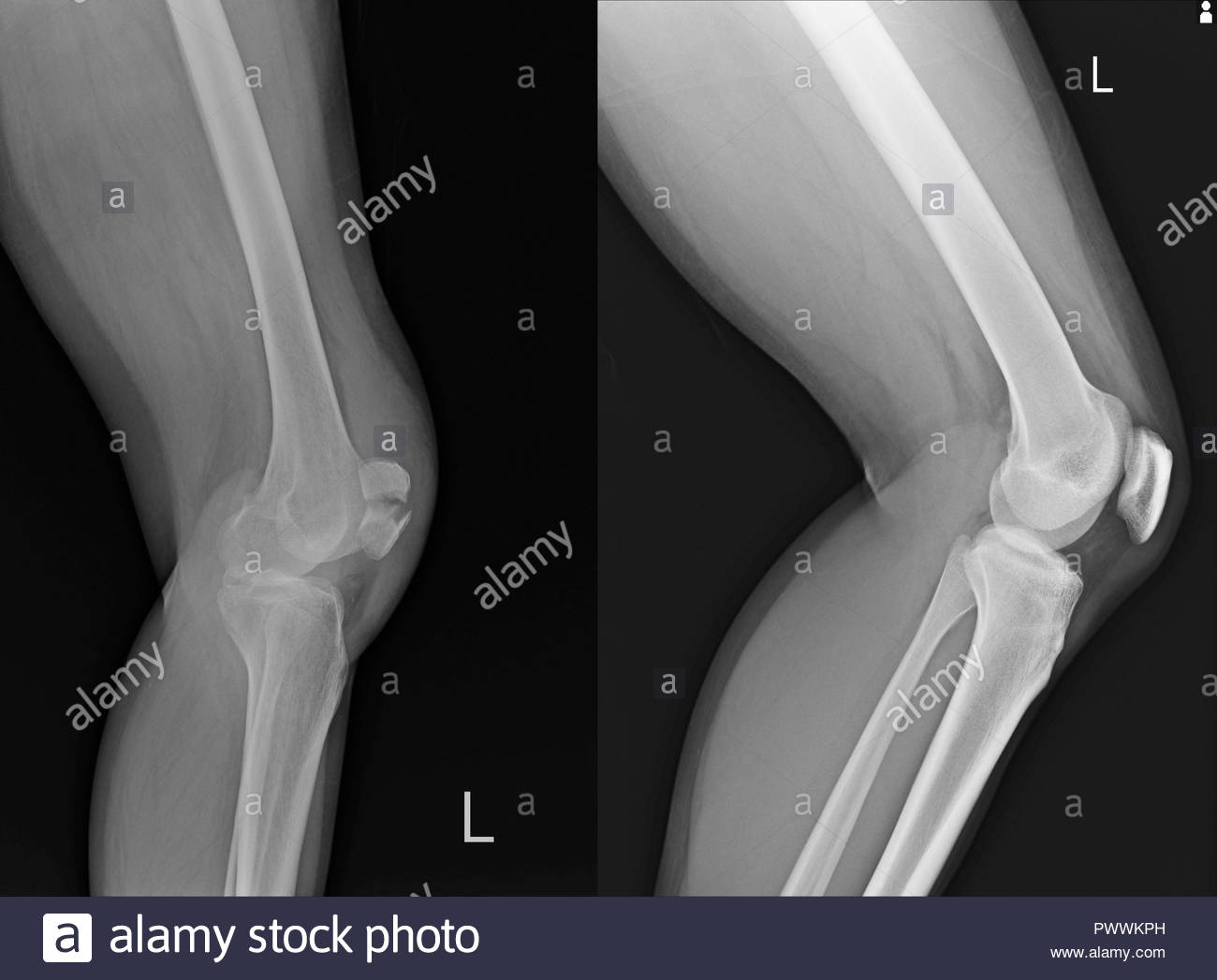 Normal Knee X Ray Stock Photos & Normal Knee X Ray Stock Images - Alamy Normal Knee X Ray Stock Photos & Normal Knee X Ray Stock Images - Alamy