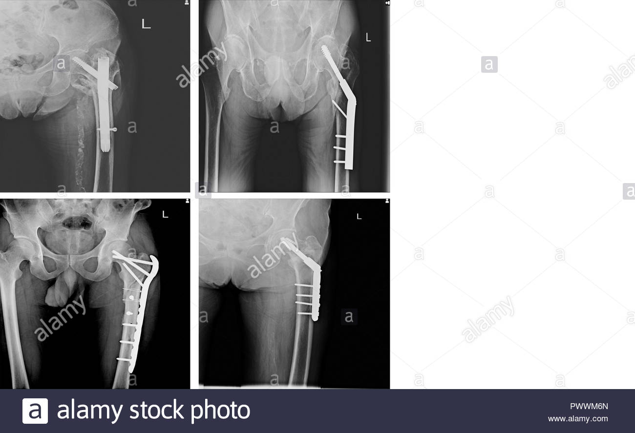 Orthopedic Surgery Stock Photos & Orthopedic Surgery Stock Images - Alamy