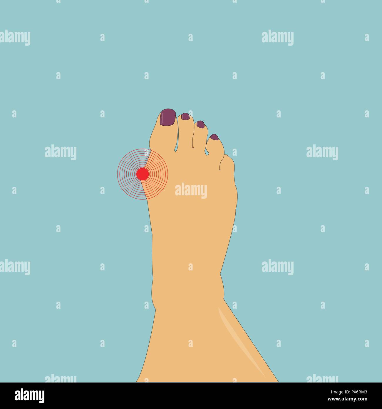 Hallux Valgus foot with a painful bunion on the green background Stock ...