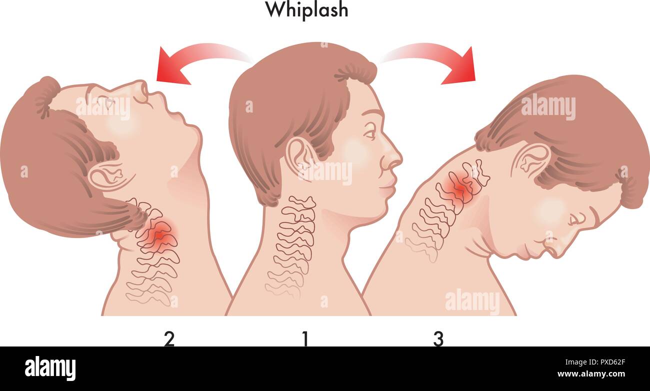 vector medical illustration of the dynamics of the whiplash injury ...