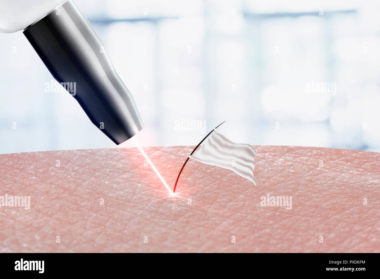 cosmetology procedure laser hair removal on body parts.hair surrender ...