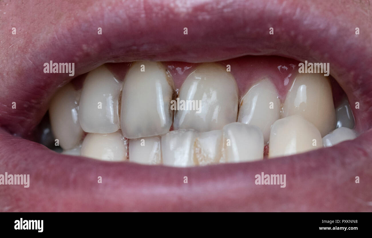 Dental plaque hi-res stock photography and images - Alamy