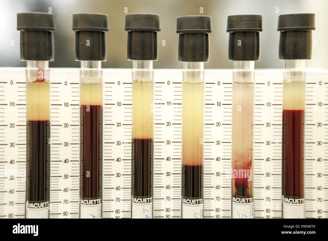 Blood group test sample analyze hi-res stock photography and images - Alamy