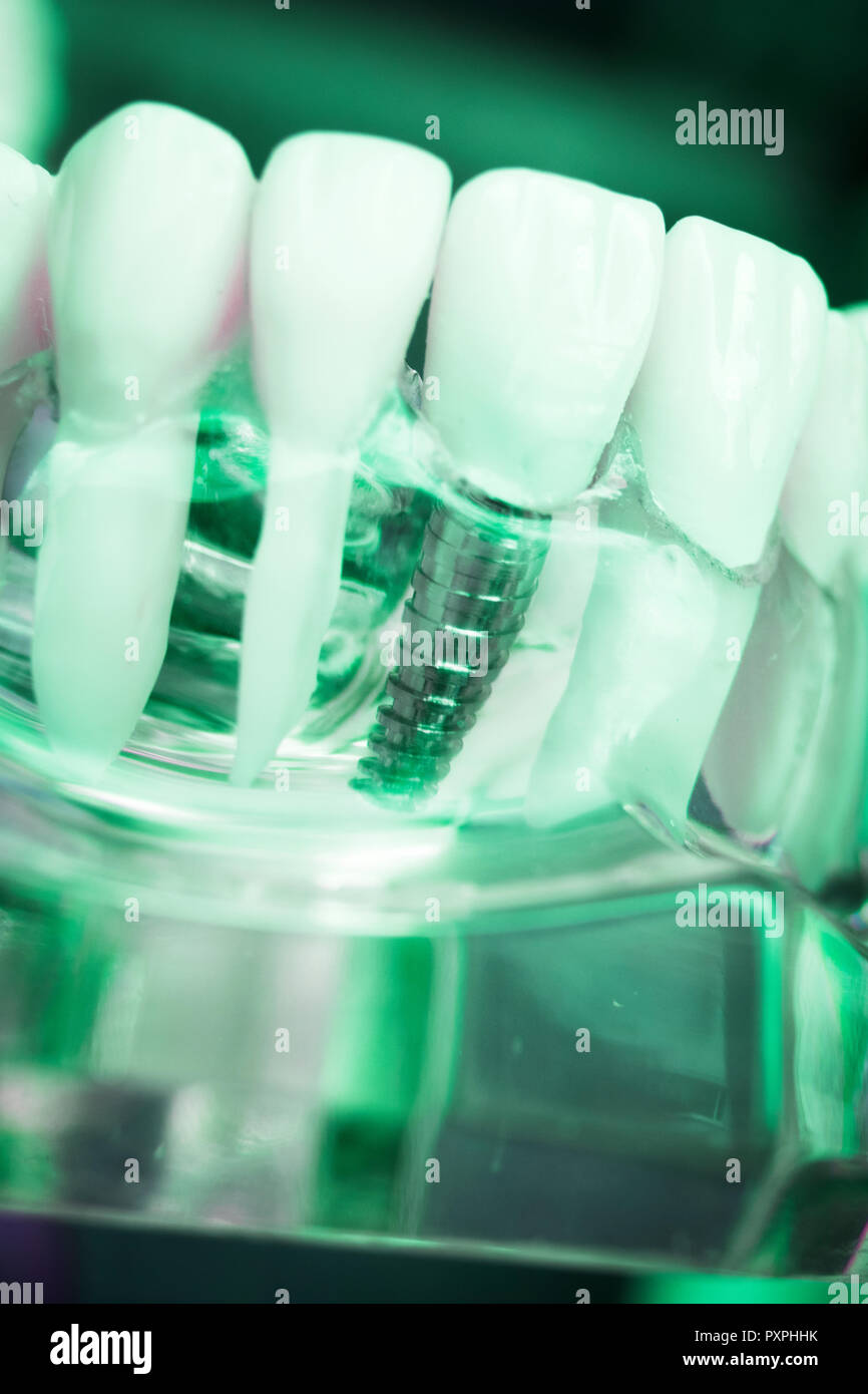 Dentist dental teeth teaching model showing titanium metal tooth ...