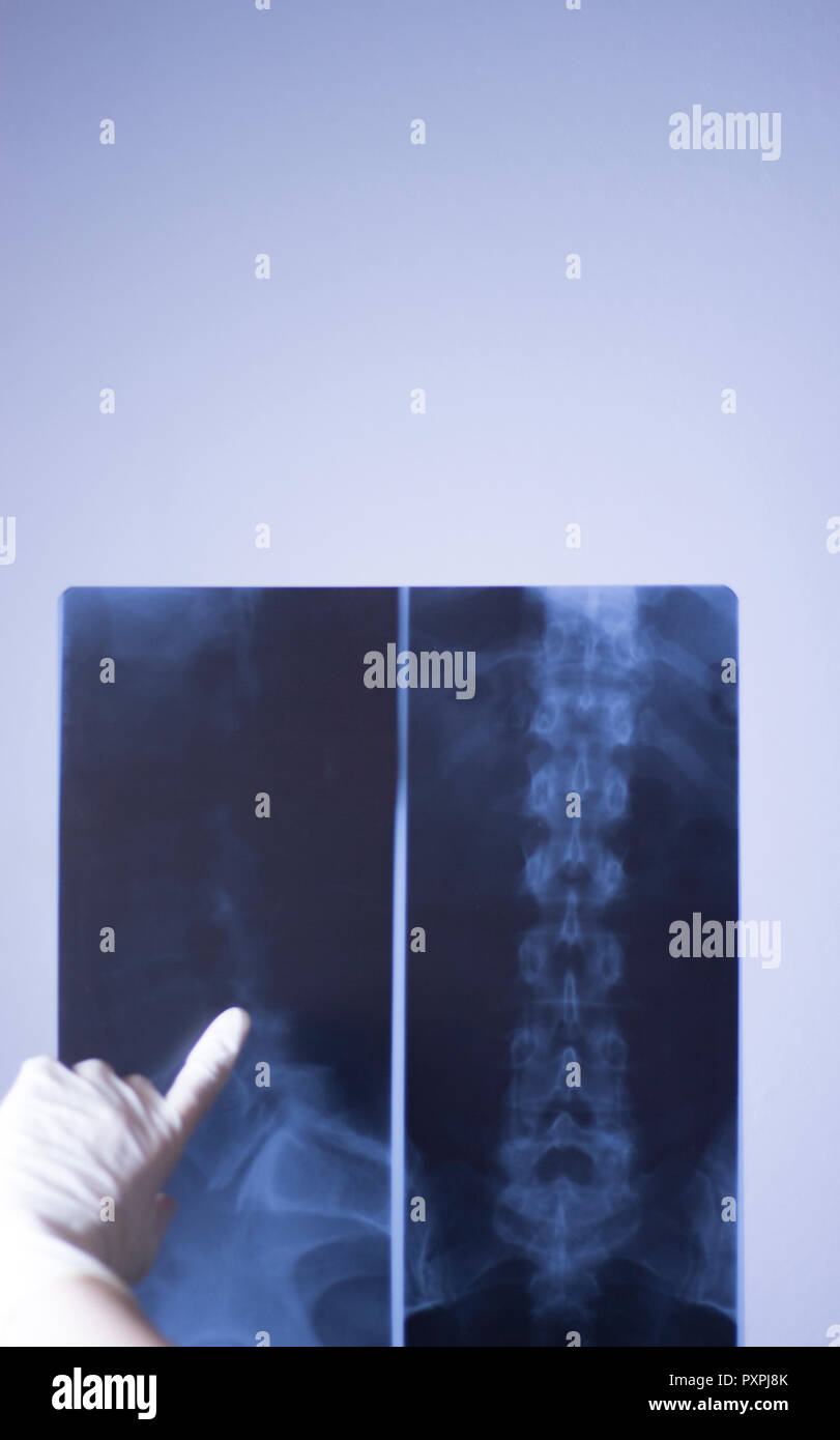 Medical hospital x-ray lowe back pain spine and hips traumatology scan ...