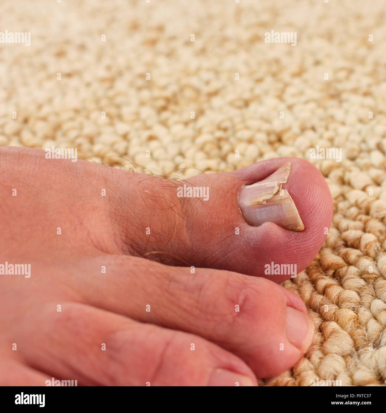 Broken toenail man hi-res stock photography and images - Alamy
