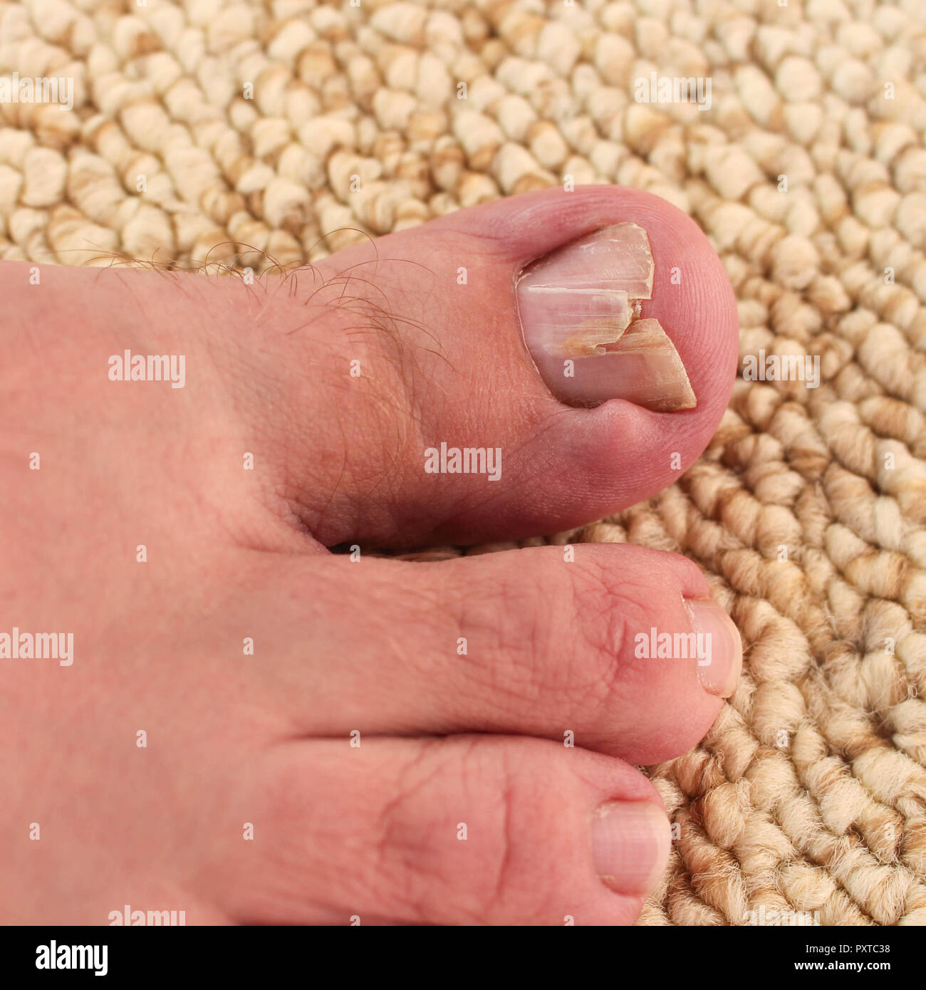 Big toe fracture hi-res stock photography and images - Alamy