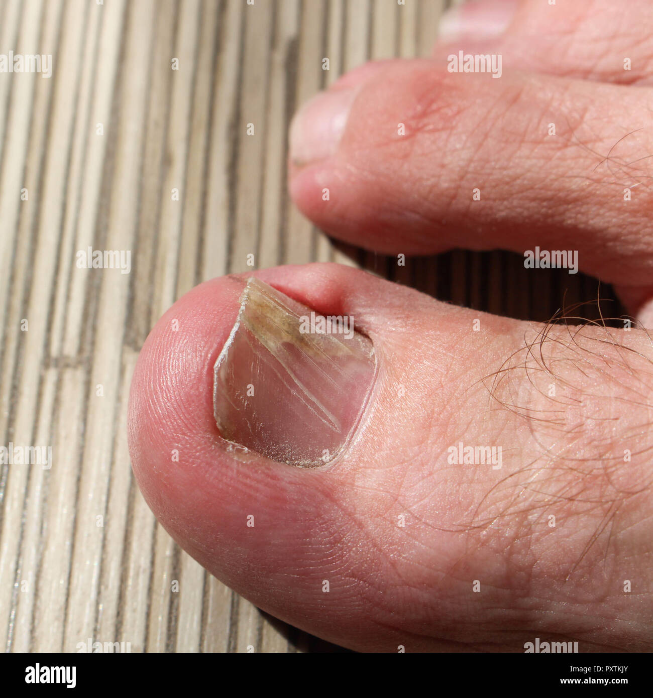 Big toe fracture hi-res stock photography and images - Alamy