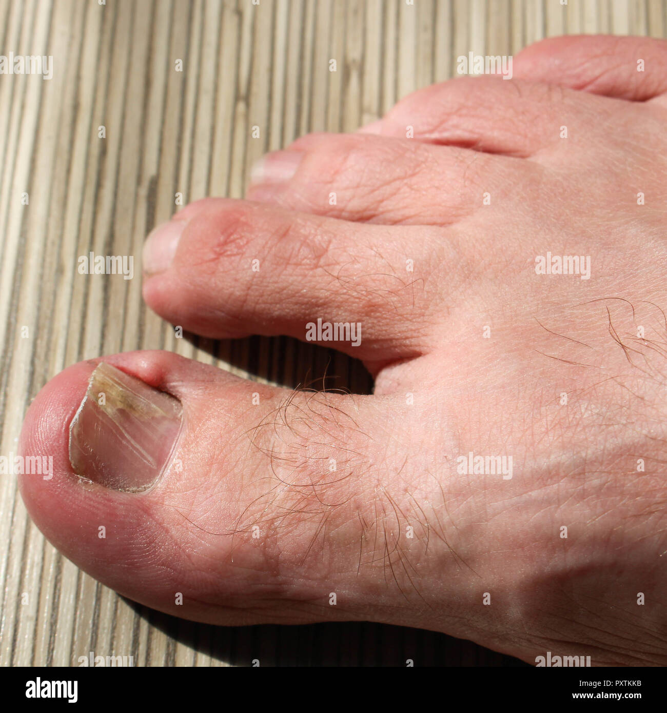 Big toe fracture hi-res stock photography and images - Alamy