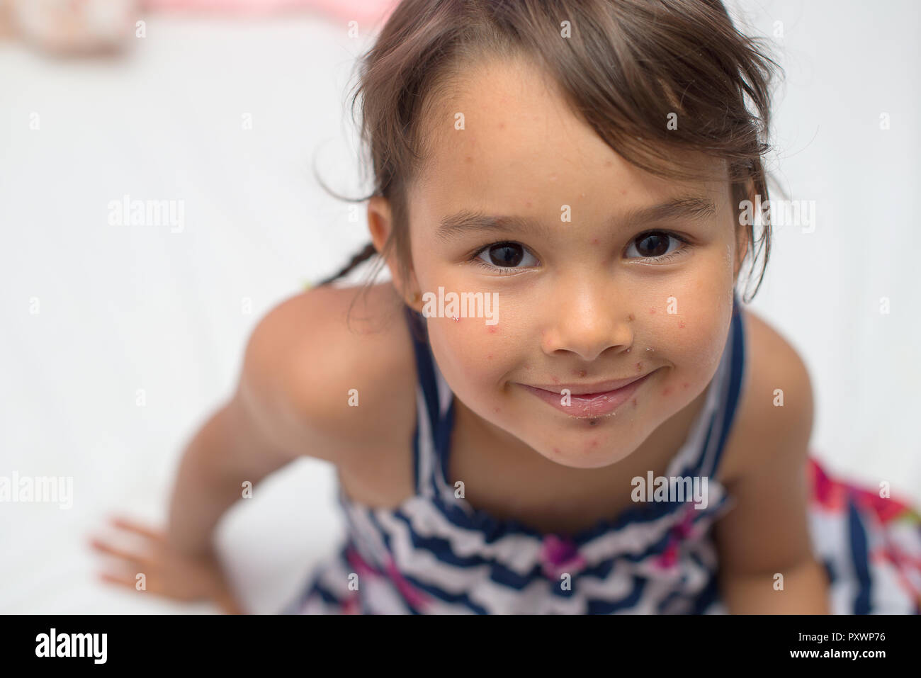 Girl chickenpox spots hi-res stock photography and images - Alamy