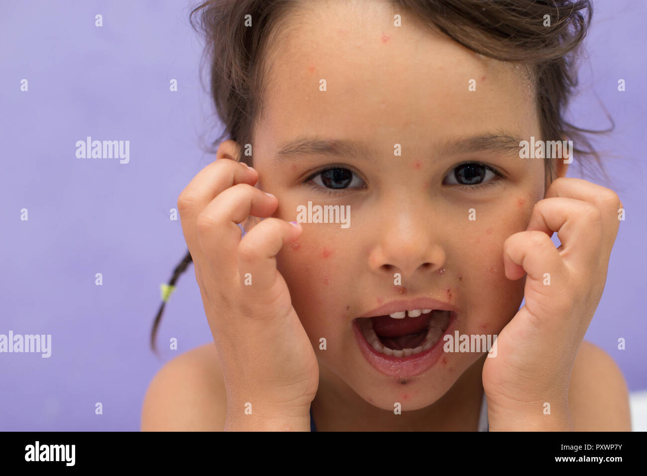 Small pox virus hi-res stock photography and images - Alamy