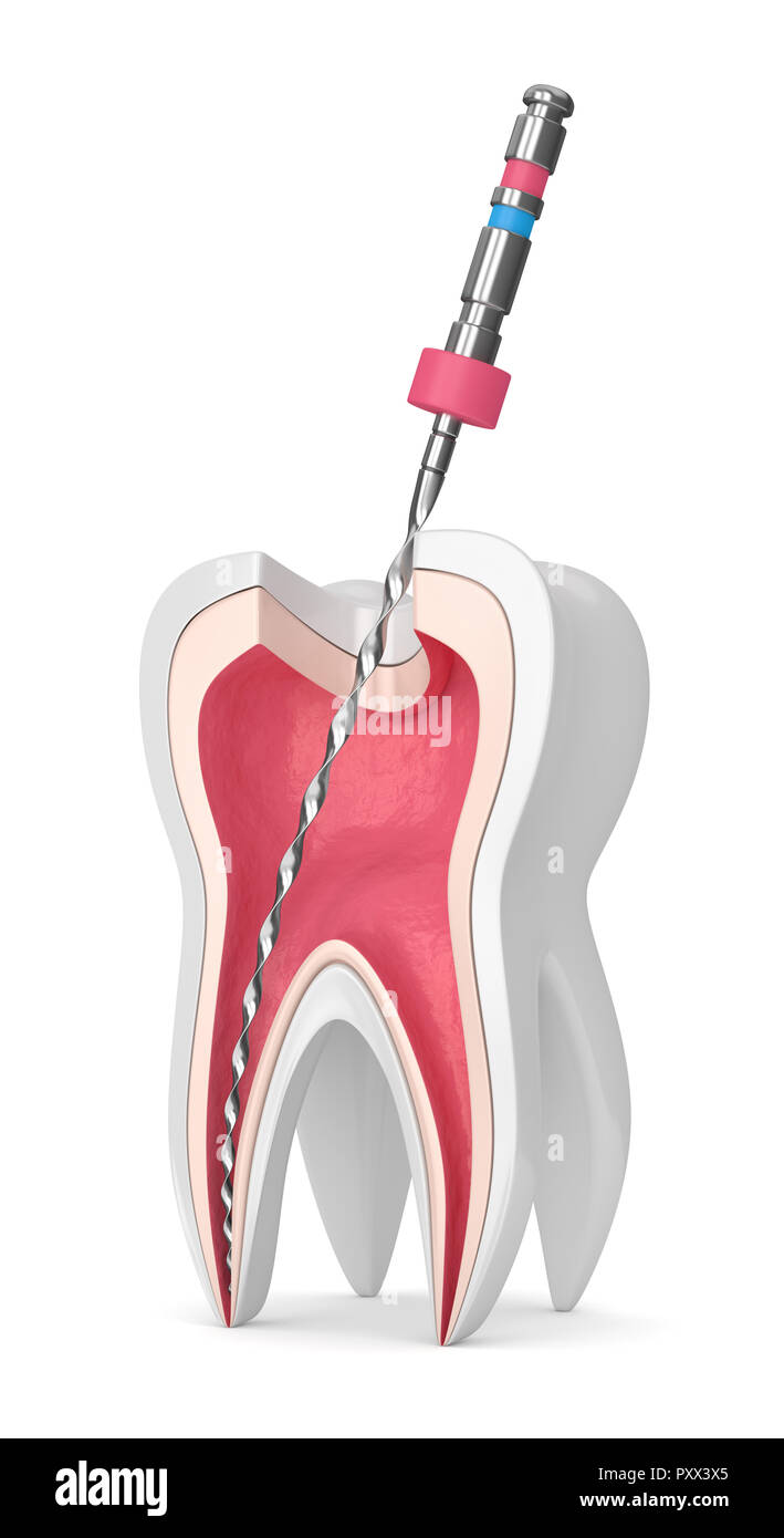 3d render of tooth with endodontic file over white background. Root ...