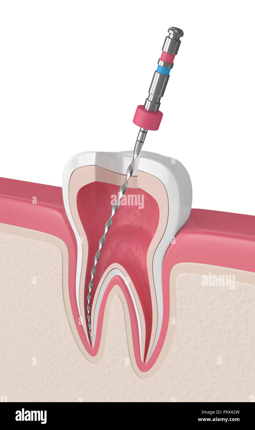 3d render of tooth with endodontic file in gums. Root canal treatment ...