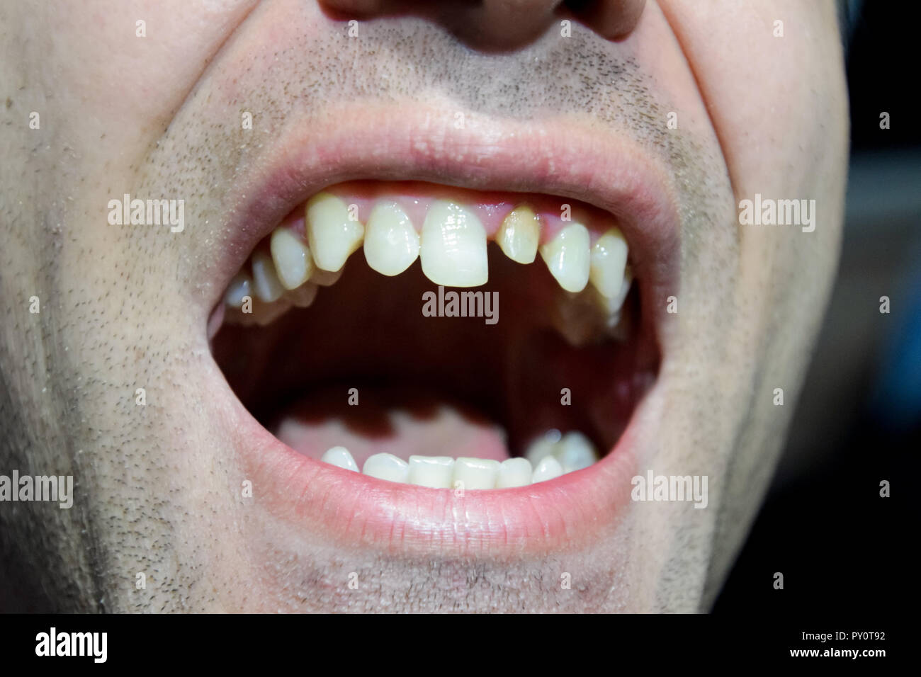 The process of replacing a tooth. Preparation of the tooth under the ...