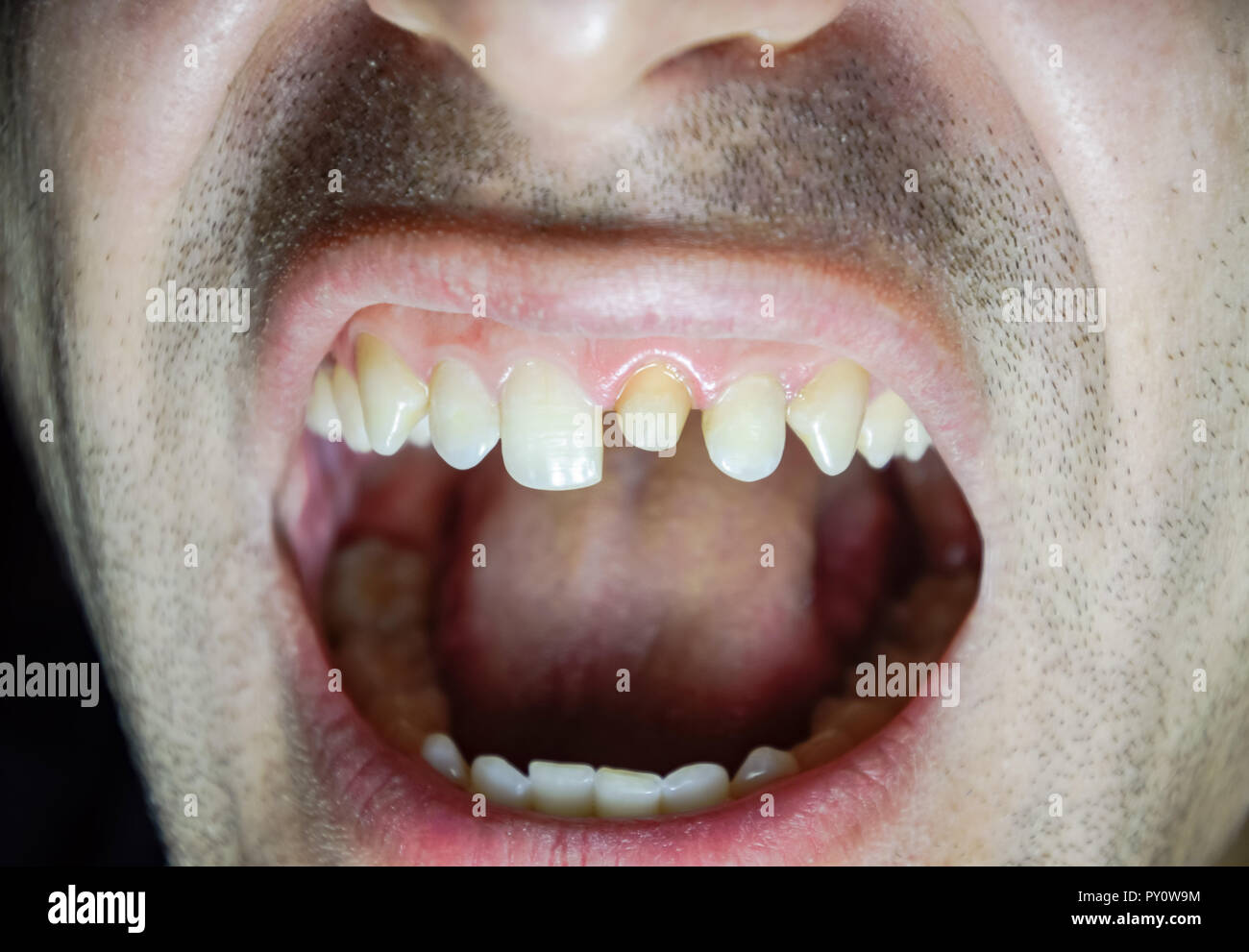 The process of replacing a tooth. Preparation of the tooth under the ...