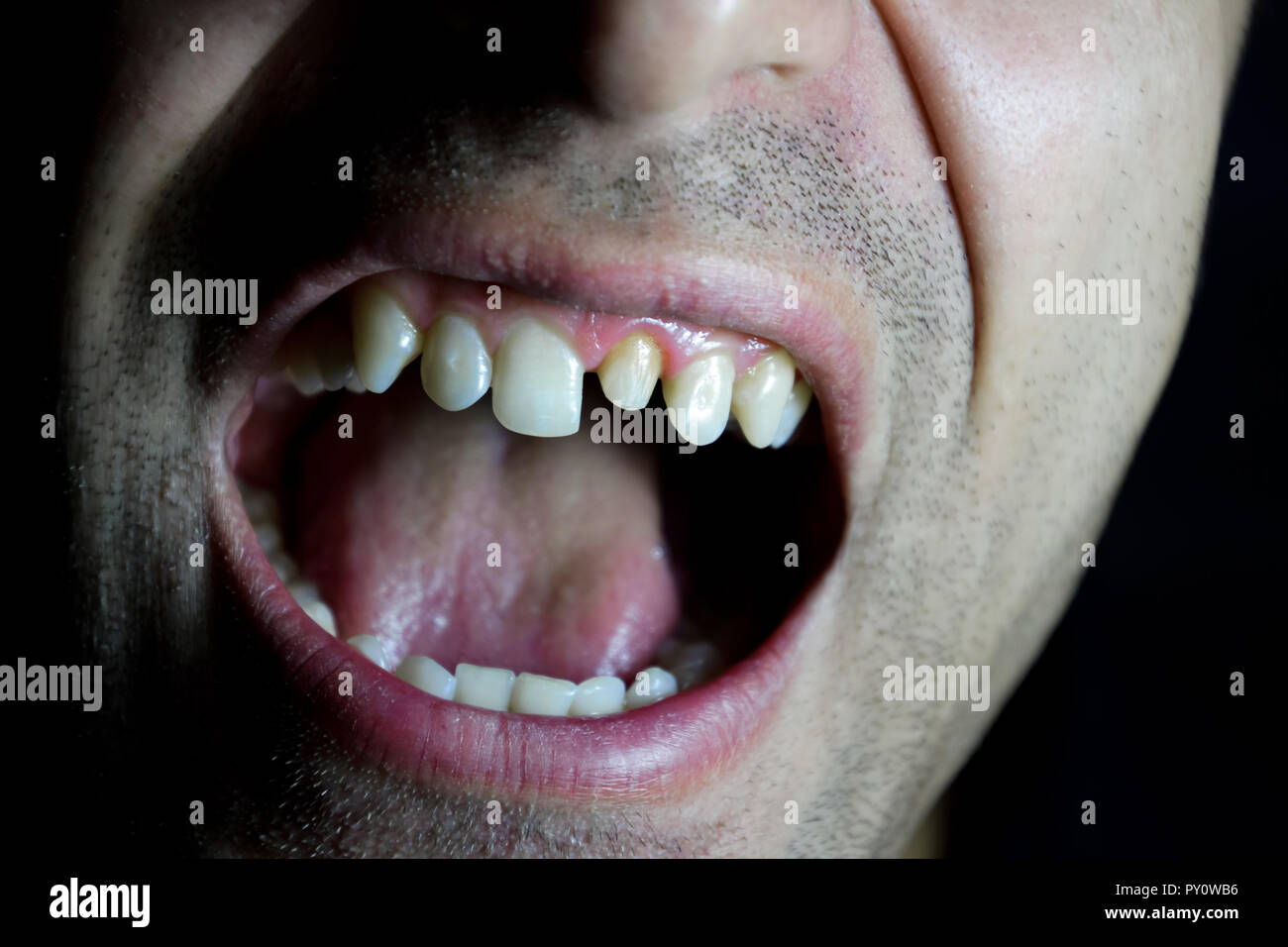 The process of replacing a tooth. Preparation of the tooth under the ...