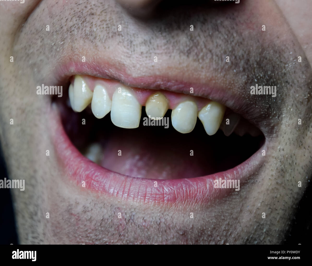 The process of replacing a tooth. Preparation of the tooth under the ...