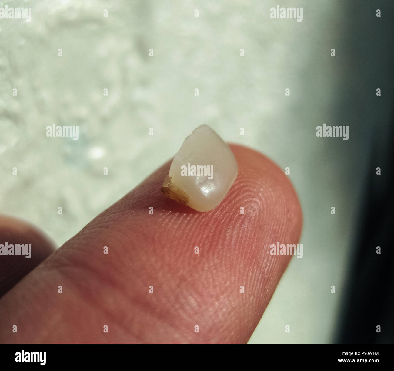 Fallen off old filling with a cutter. The seal of the tooth Stock Photo ...