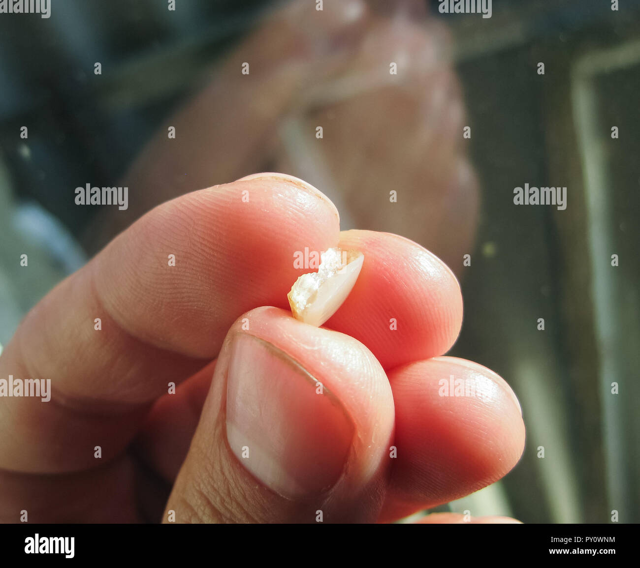 Fallen off old filling with a cutter. The seal of the tooth Stock Photo ...