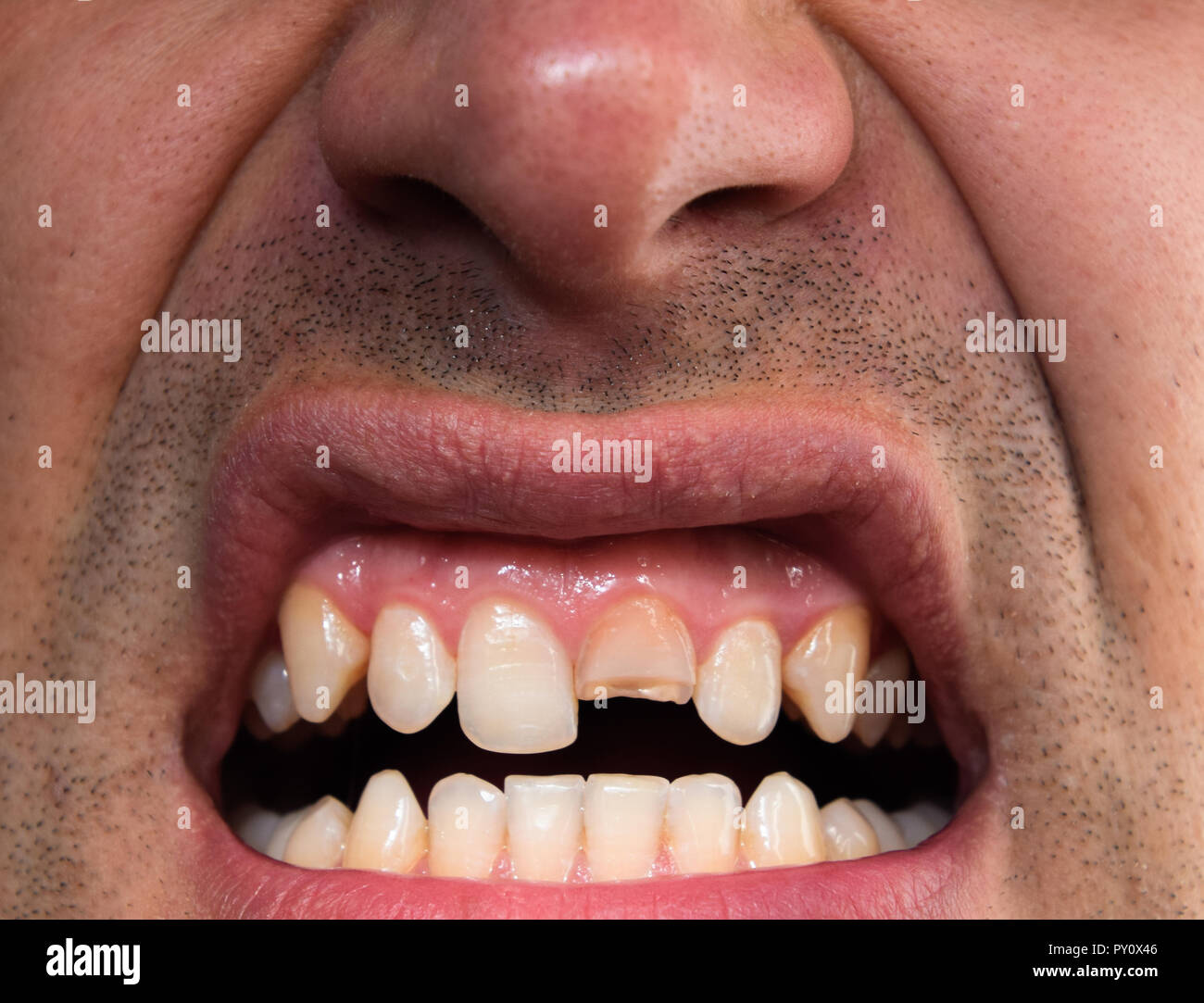 Protecting A Broken Tooth