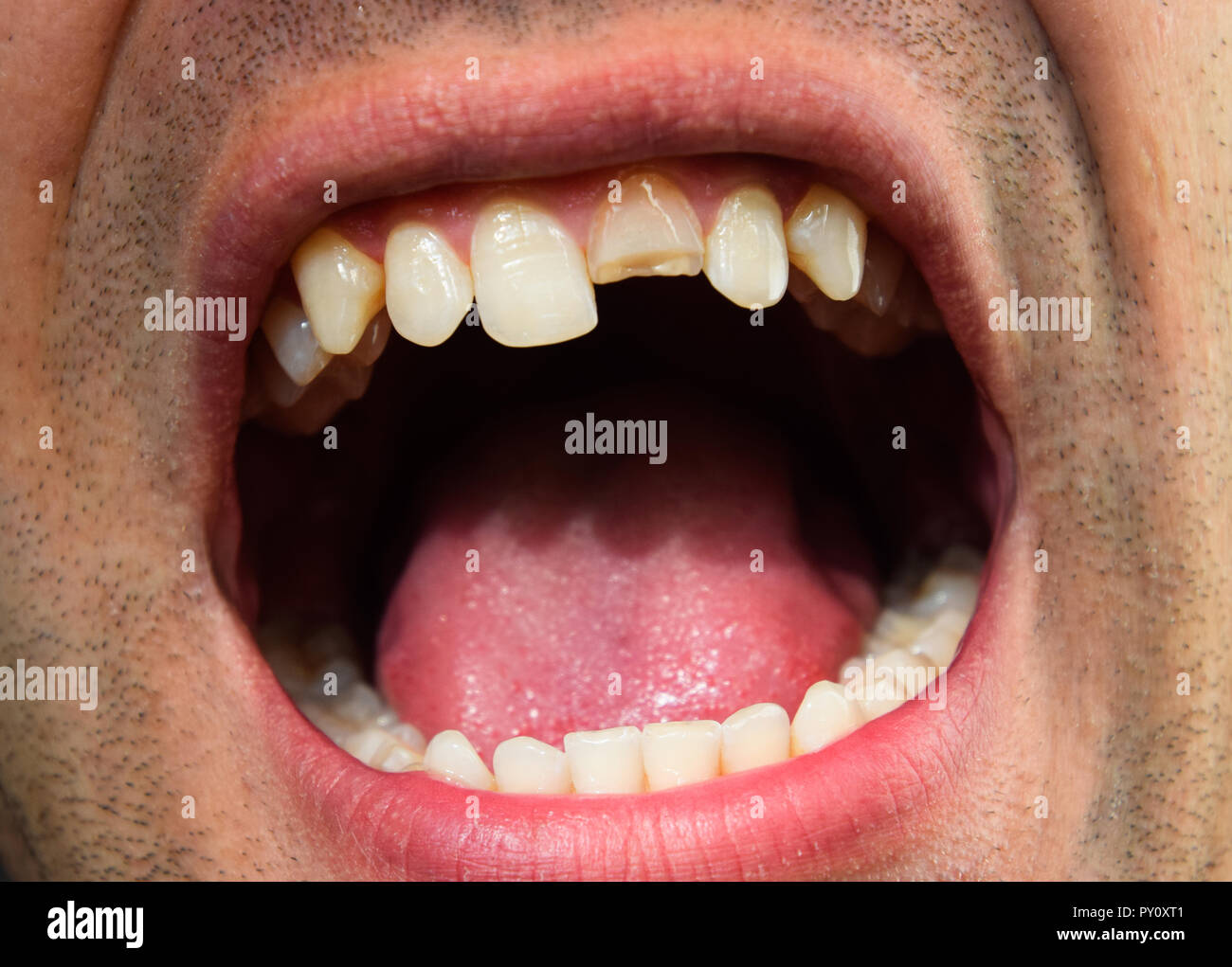 Broken tooth. Broken upper incisor in a man mouth Stock Photo - Alamy