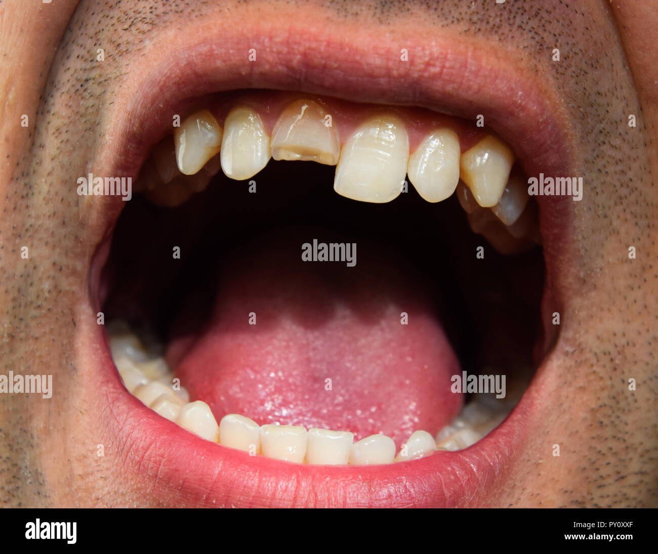 Broken tooth. Broken upper incisor in a man mouth Stock Photo - Alamy