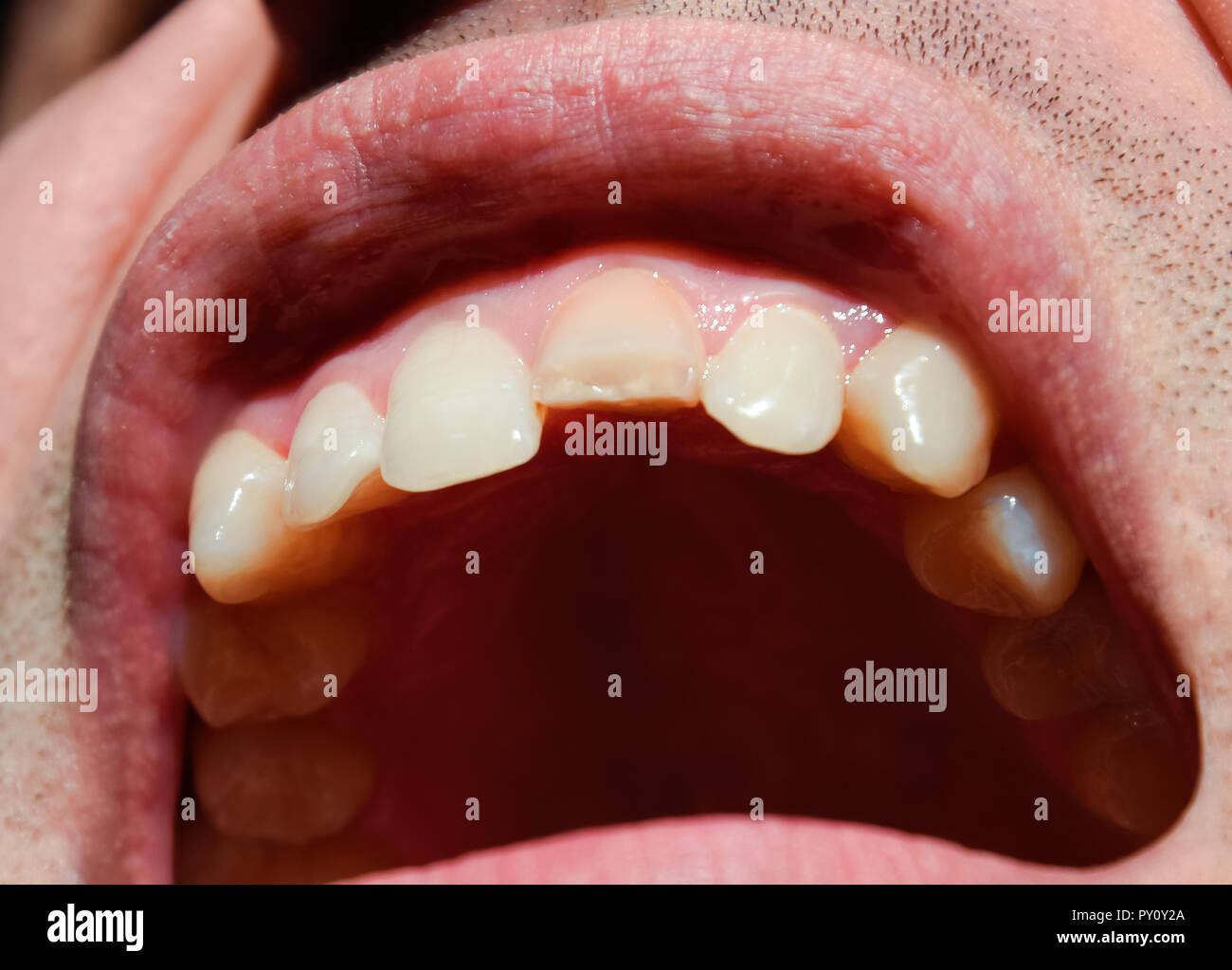 Broken tooth. Broken upper incisor in a man mouth Stock Photo - Alamy