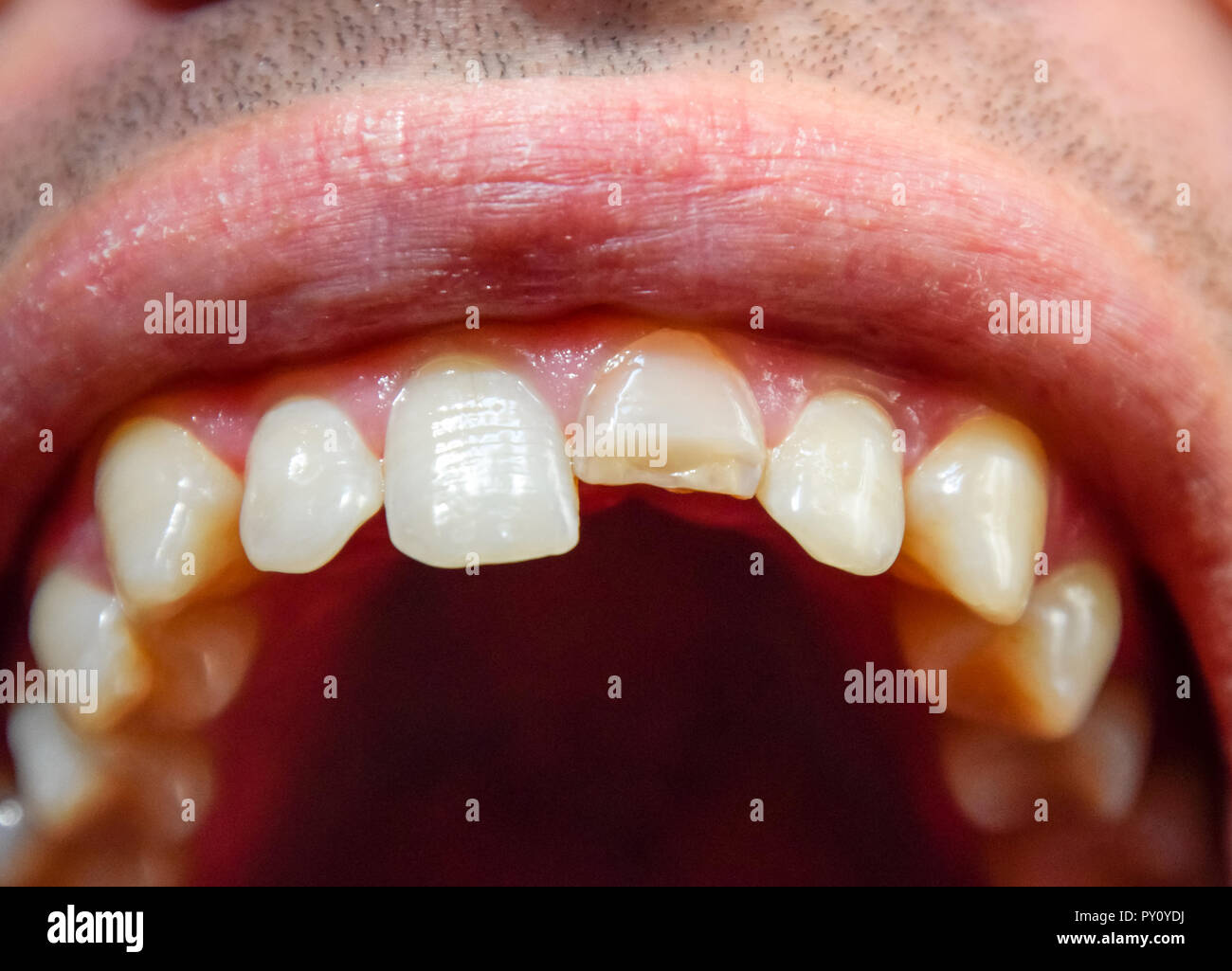 Broken tooth. Broken upper incisor in a man mouth Stock Photo - Alamy