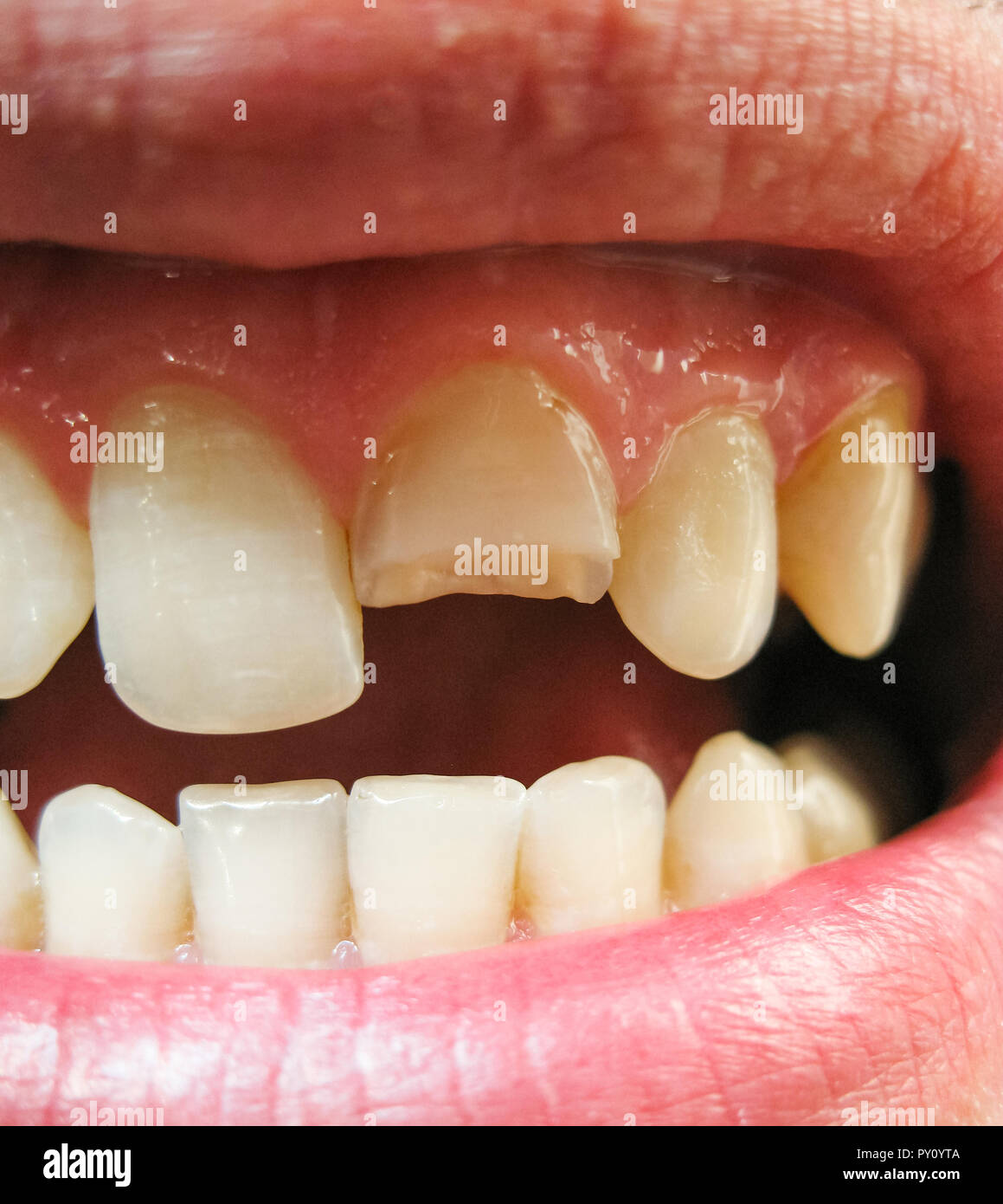 Broken tooth. Broken upper incisor in a man mouth Stock Photo - Alamy