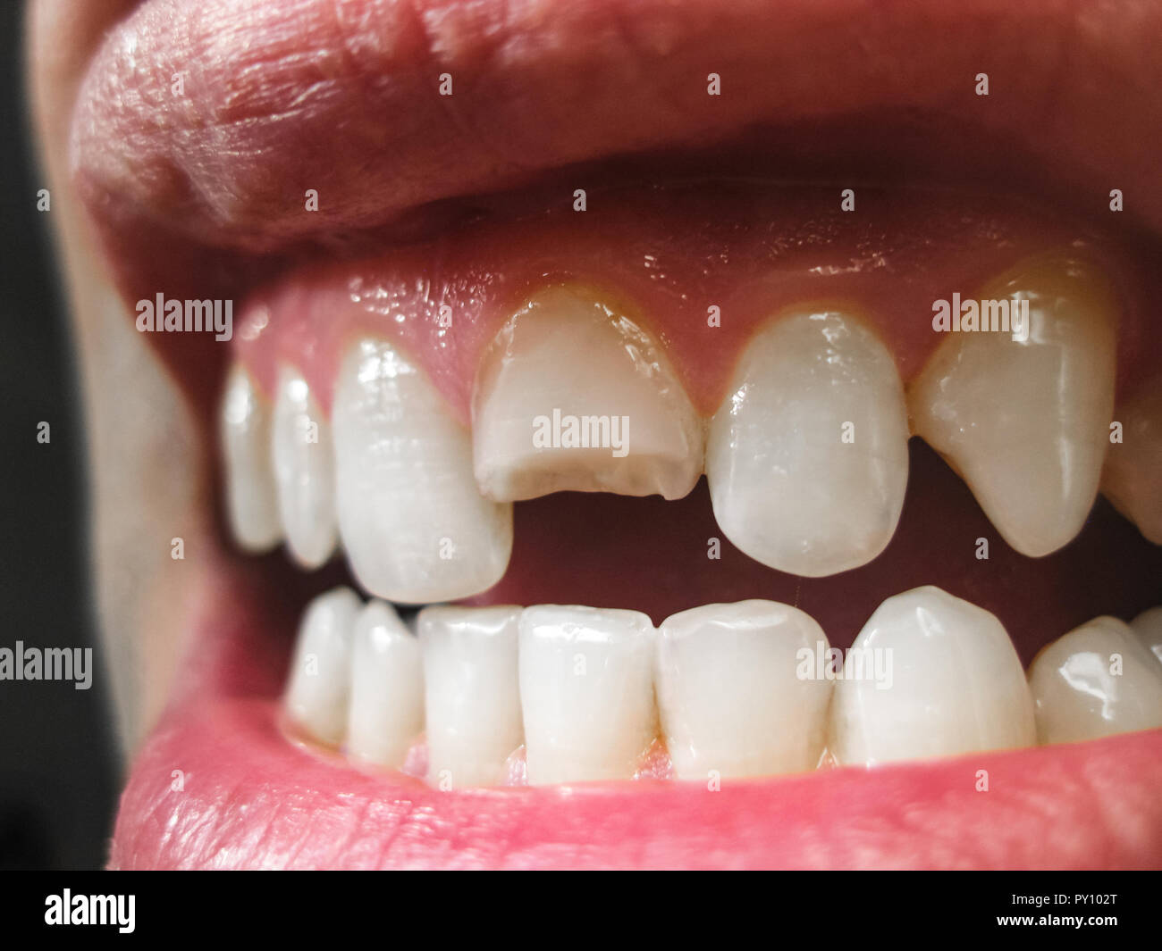 Broken tooth. Broken upper incisor in a man mouth Stock Photo - Alamy