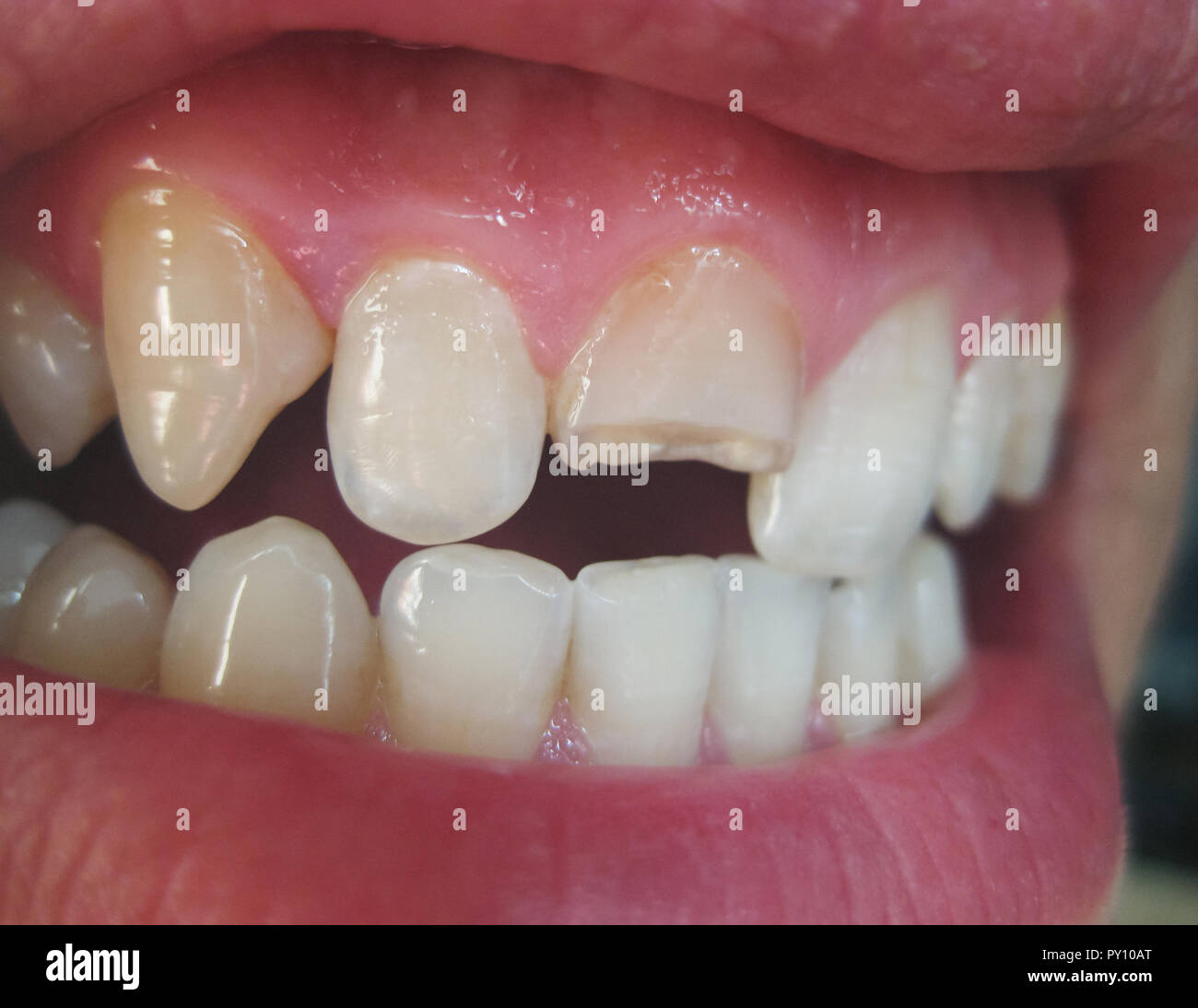 Broken tooth. Broken upper incisor in a man mouth Stock Photo - Alamy