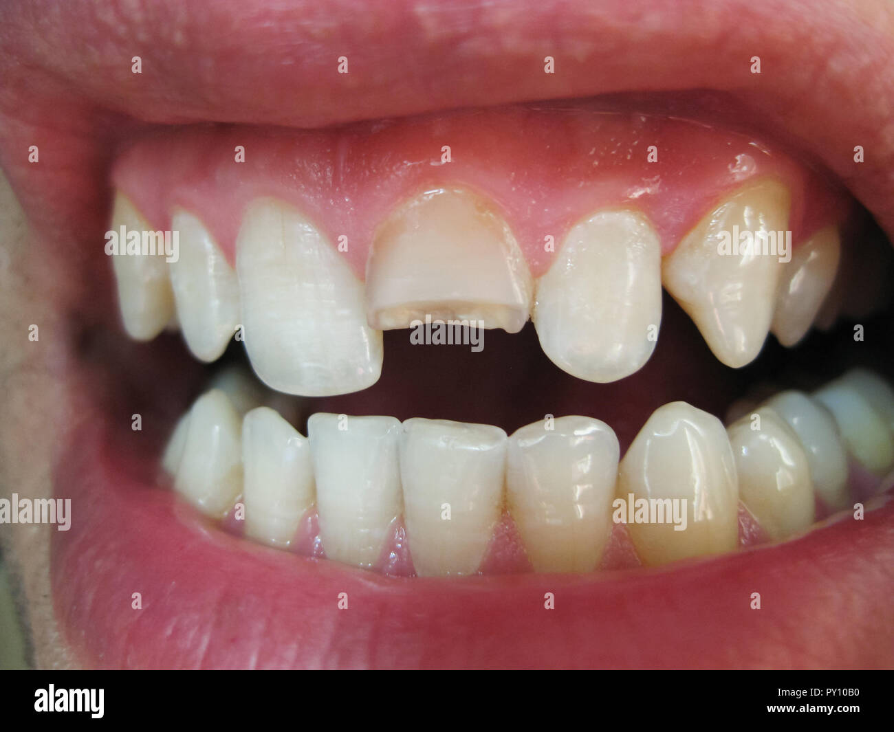 Broken tooth. Broken upper incisor in a man mouth Stock Photo - Alamy