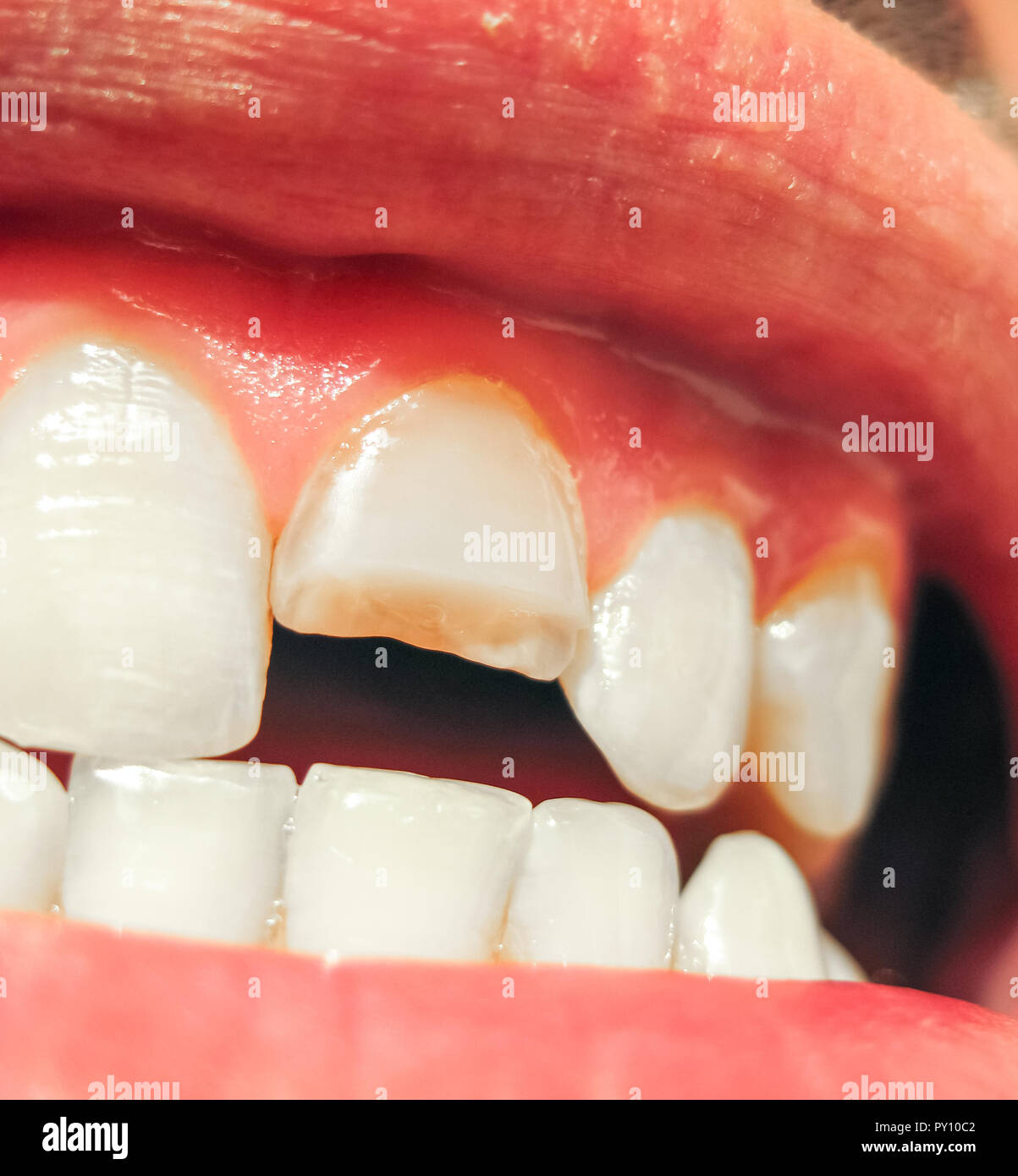 Broken tooth. Broken upper incisor in a man mouth Stock Photo - Alamy