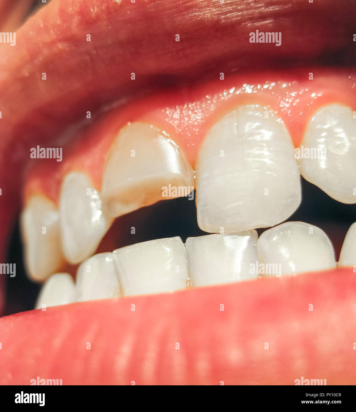 Broken tooth. Broken upper incisor in a man mouth Stock Photo - Alamy