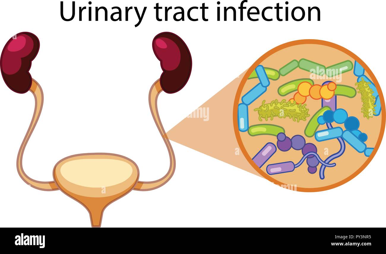 Human Urinary Tract Infection illustration Stock Vector Image & Art - Alamy
