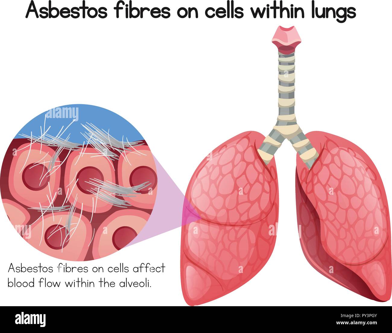 Asbestos Fibres on Cells Within Lungs illustration Stock Vector Image ...
