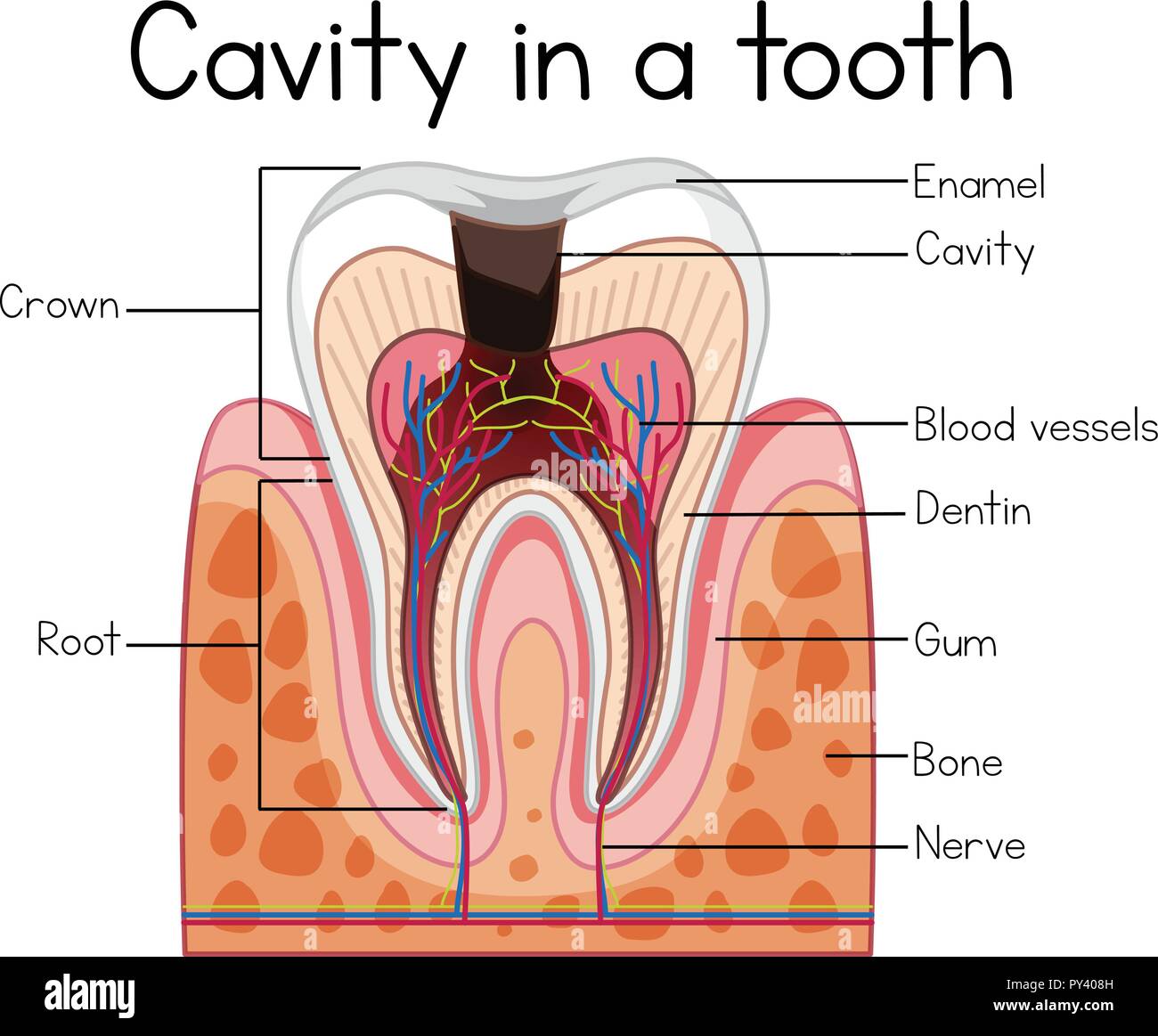 Cavity in a tooth illustration Stock Vector Image & Art - Alamy
