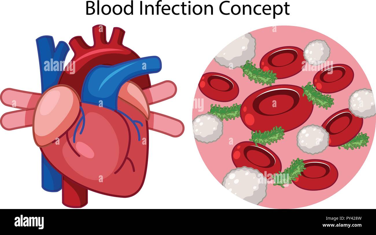 A Vector of Blood Infection Concept illustration Stock Vector Image ...