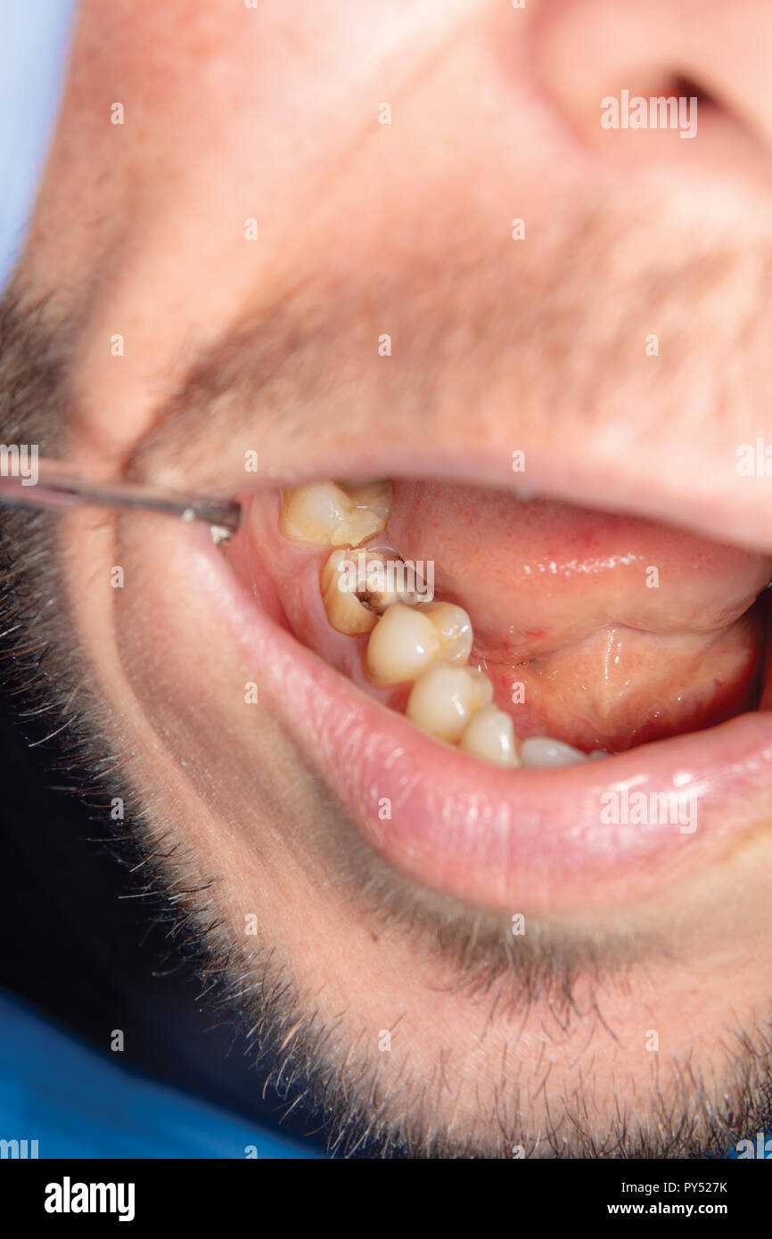 two chewing side teeth of the upper jaw after treatment of caries ...