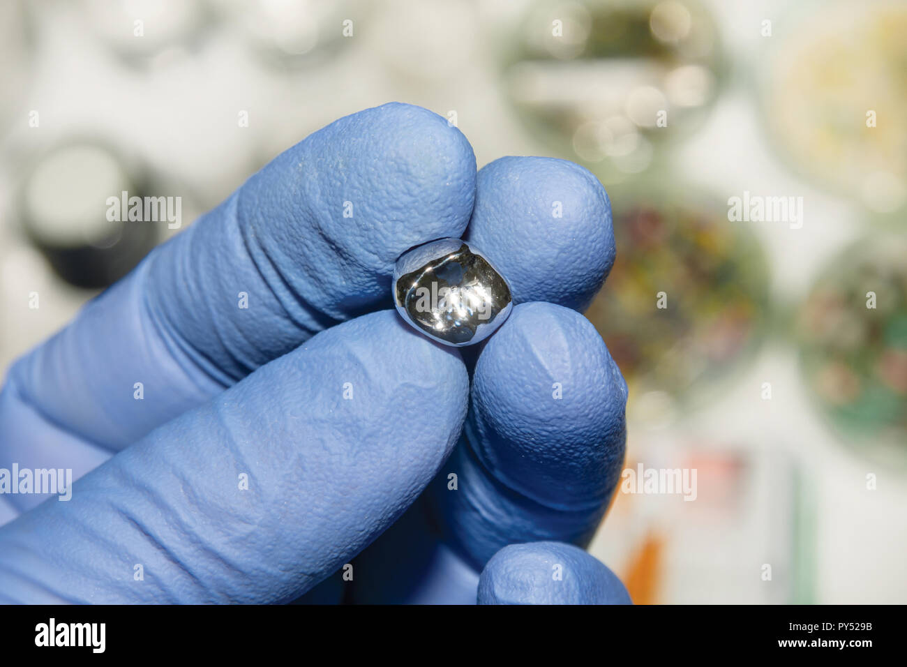 two chewing side teeth of the upper jaw after treatment of caries ...
